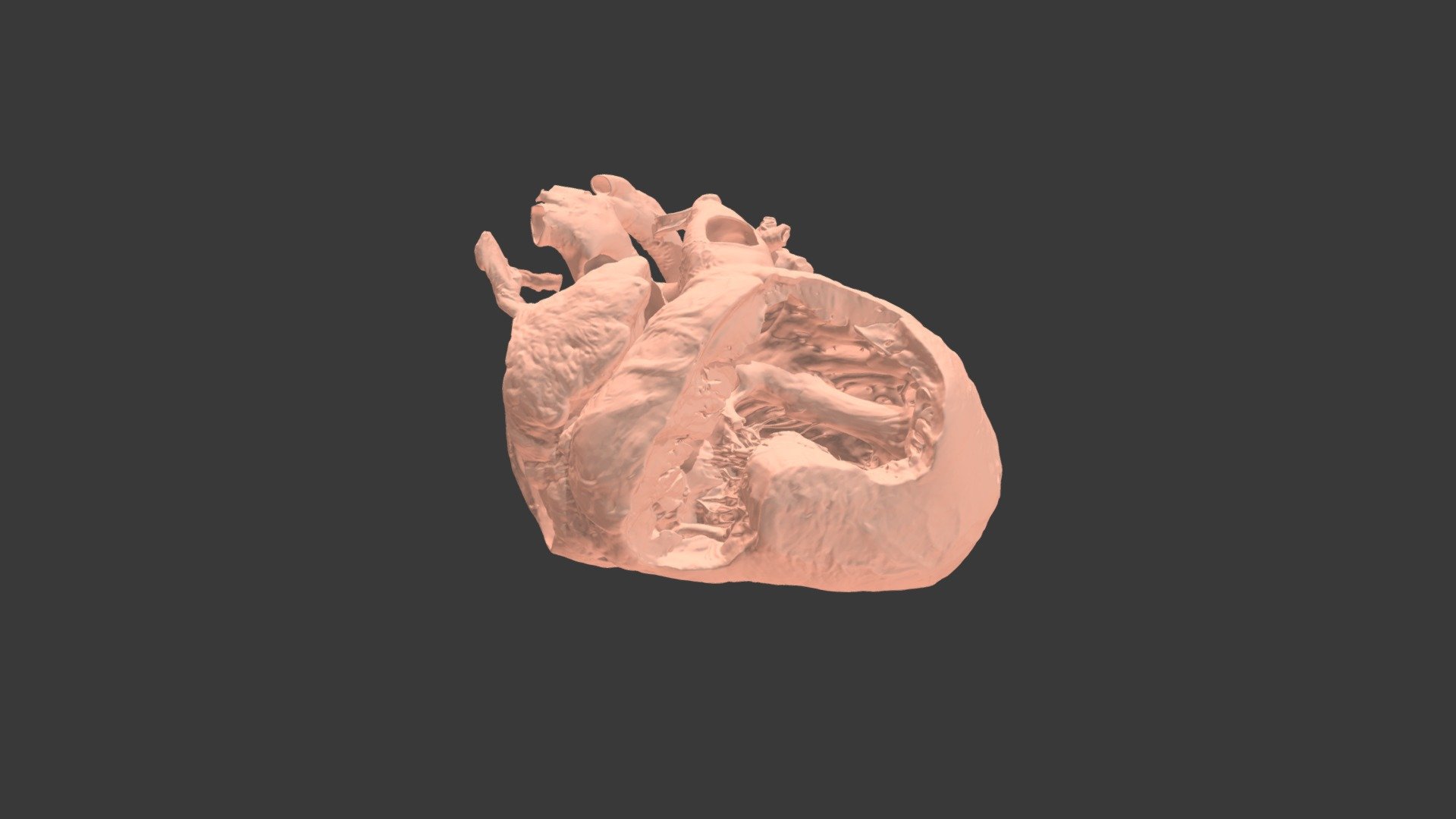 Shone's #1 - {S,D,S} with Shone's syndrome - 3D model by heartmodels ...