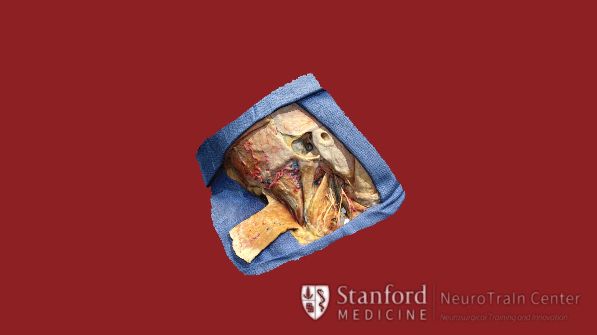 Postero-Lateral dissection with Mastoid drilling - 3D model by vv ...