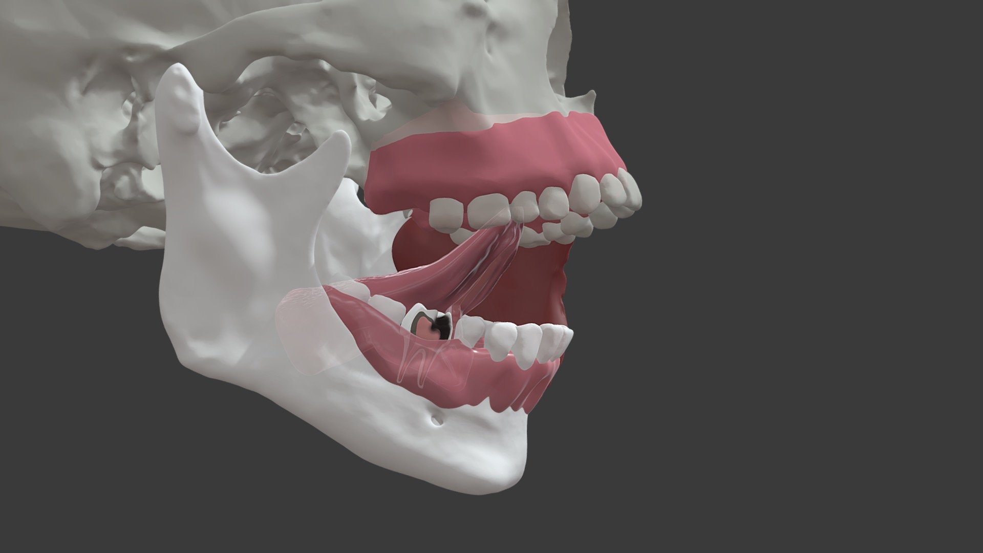 Stage 2- Mandibular Molar Infection Pathway 3 - 3D model by University ...