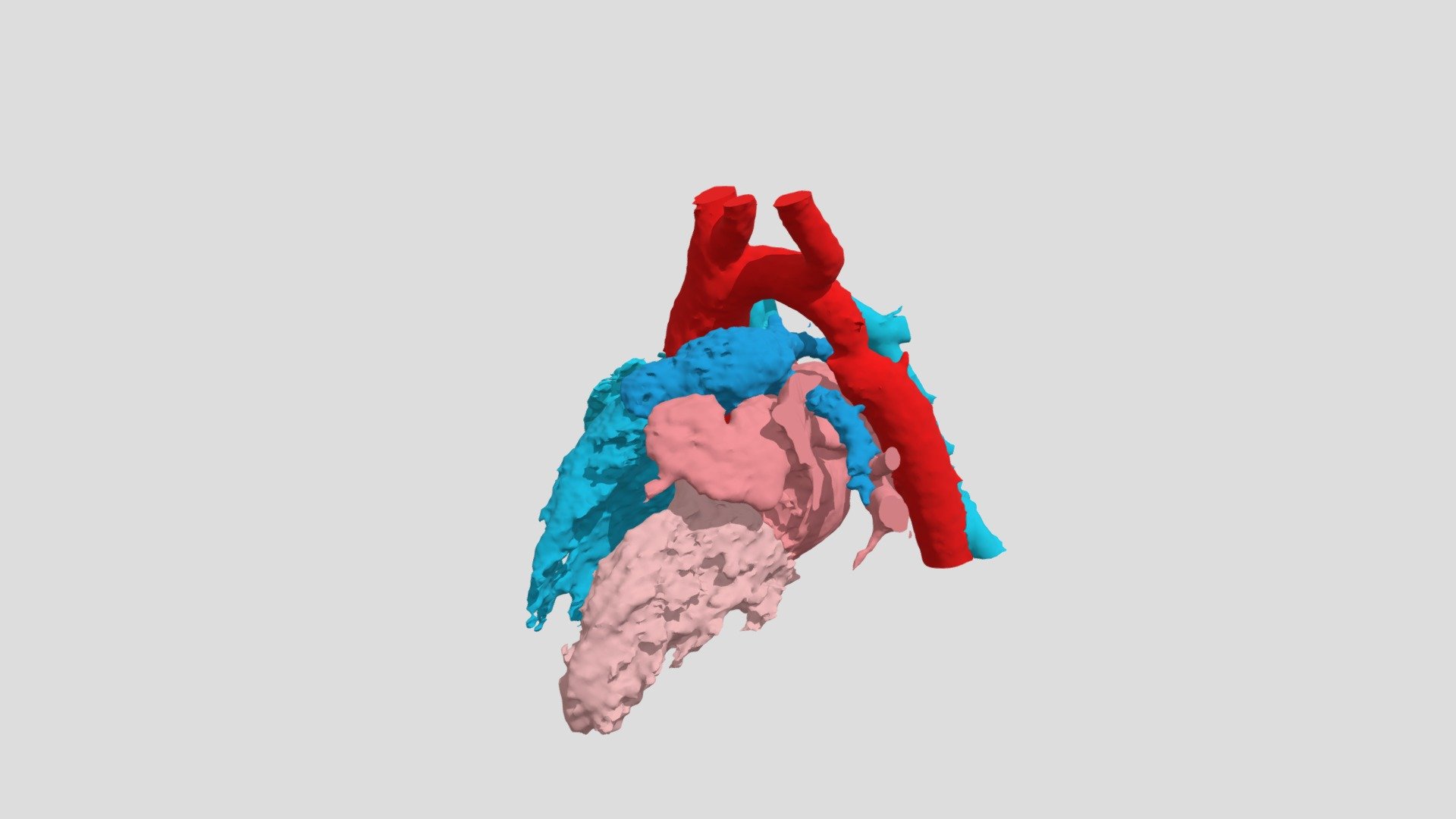 Coarctation of Aorta (S0320) - 3D model by NCH Advanced Projects ...