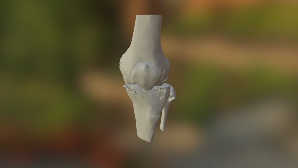 Knee - Proximal Tibia Fracture sku 062 - 3D model by orto3d [29d15a1 ...