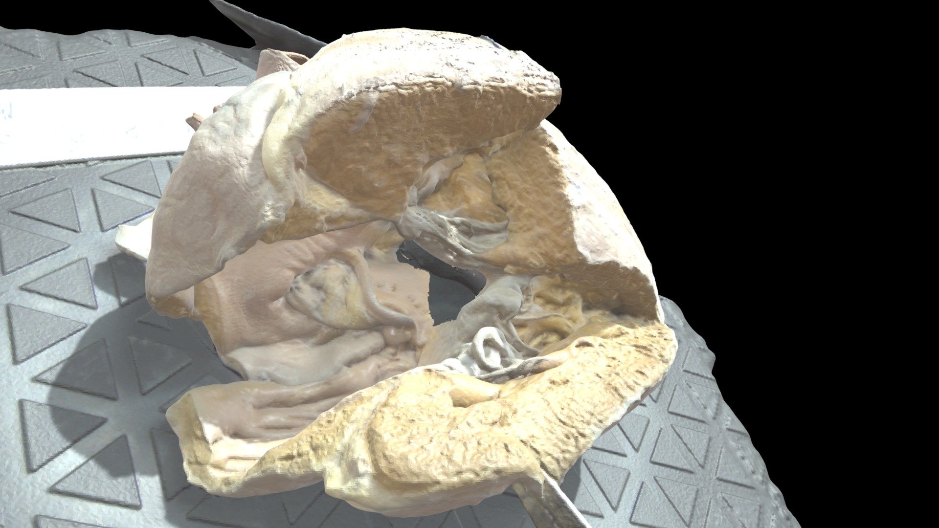 Atrioventricular septal defect ach-24 - 3D model by Rohit Loomba ...