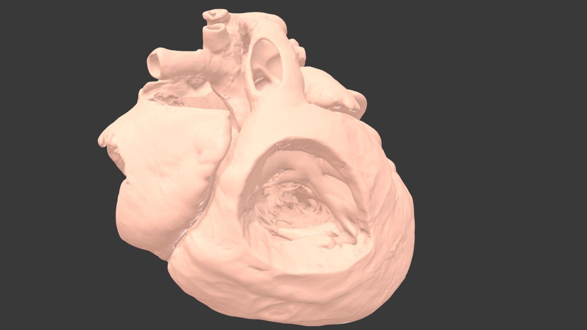 HLHS #6 - HLHS {S,D,S} (MS/AS) - 3D model by heartmodels [2ab54a9 ...