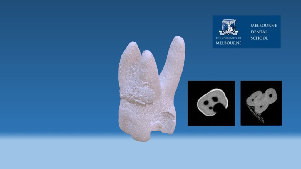 Human molar with large cavity - Download Free 3D model by Melbourne ...