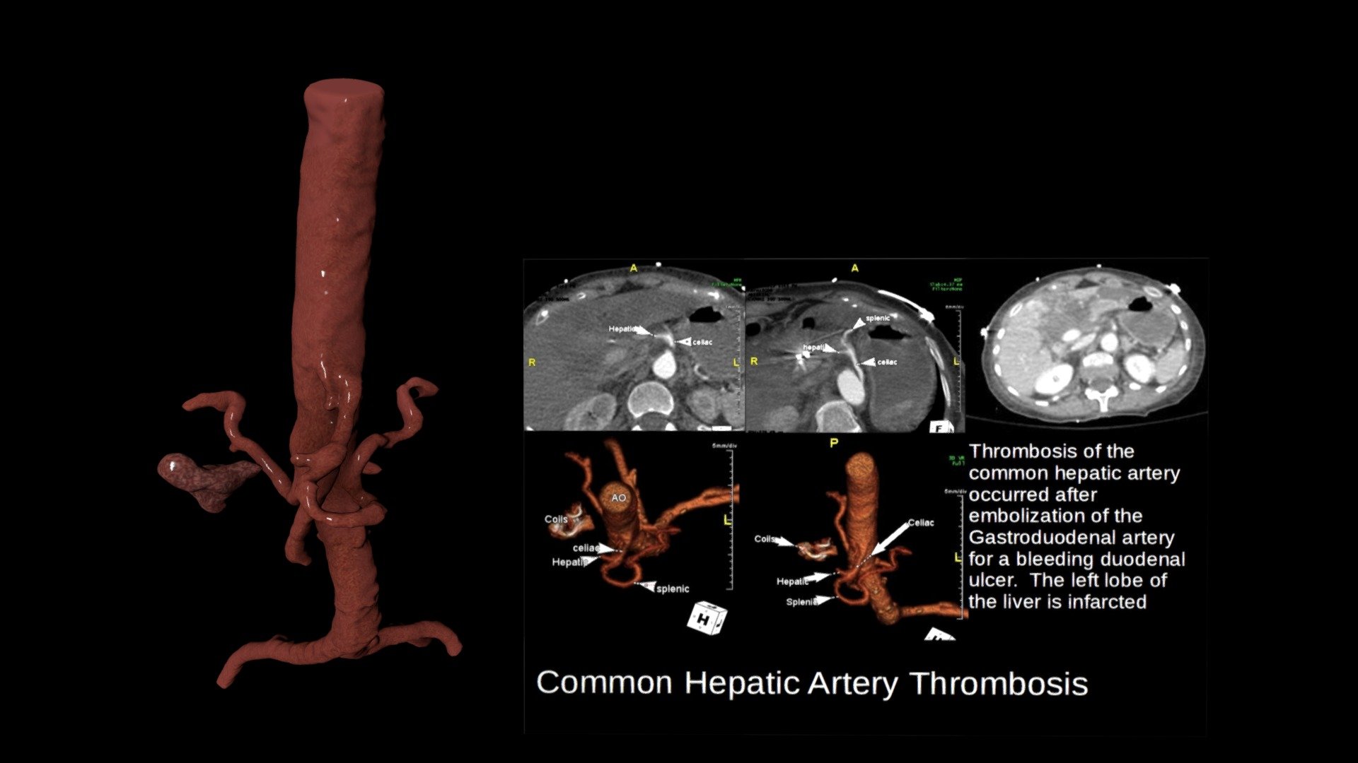 Common Hepatic Artery Thrombosis - Download Free 3D model by tl0615 ...