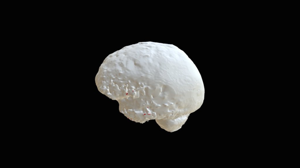 Brain With Tumor - 3D model by karthik.n.rao0110 [2be5035] - Sketchfab