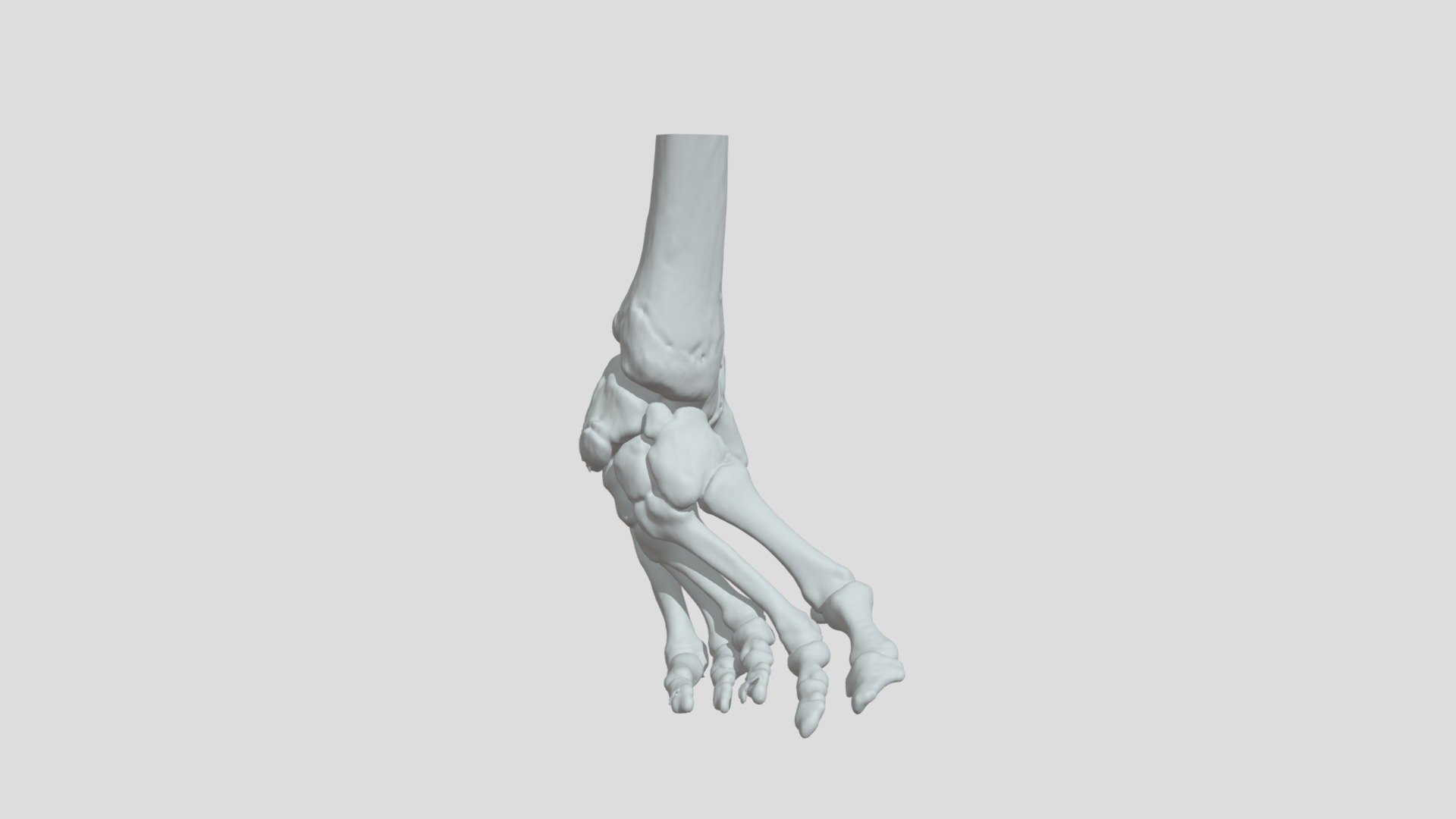 Congenital Clubfoot (S0370) - 3D model by NCH Advanced Projects ...