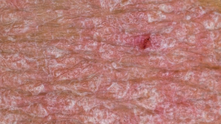 Psoriasis 3D models - Sketchfab