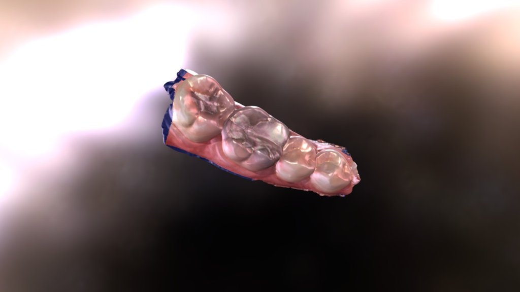 large amalgam filling - 3D model by CADucation [2caa5bd] - Sketchfab