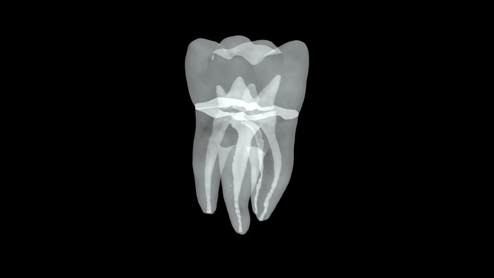 Tooth 14C - 3D model by biomed3d [2cdd544] - Sketchfab