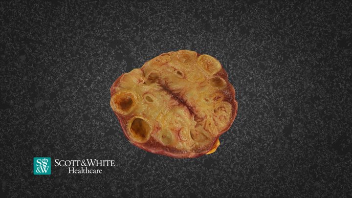 Tuberculosis 3D models - Sketchfab