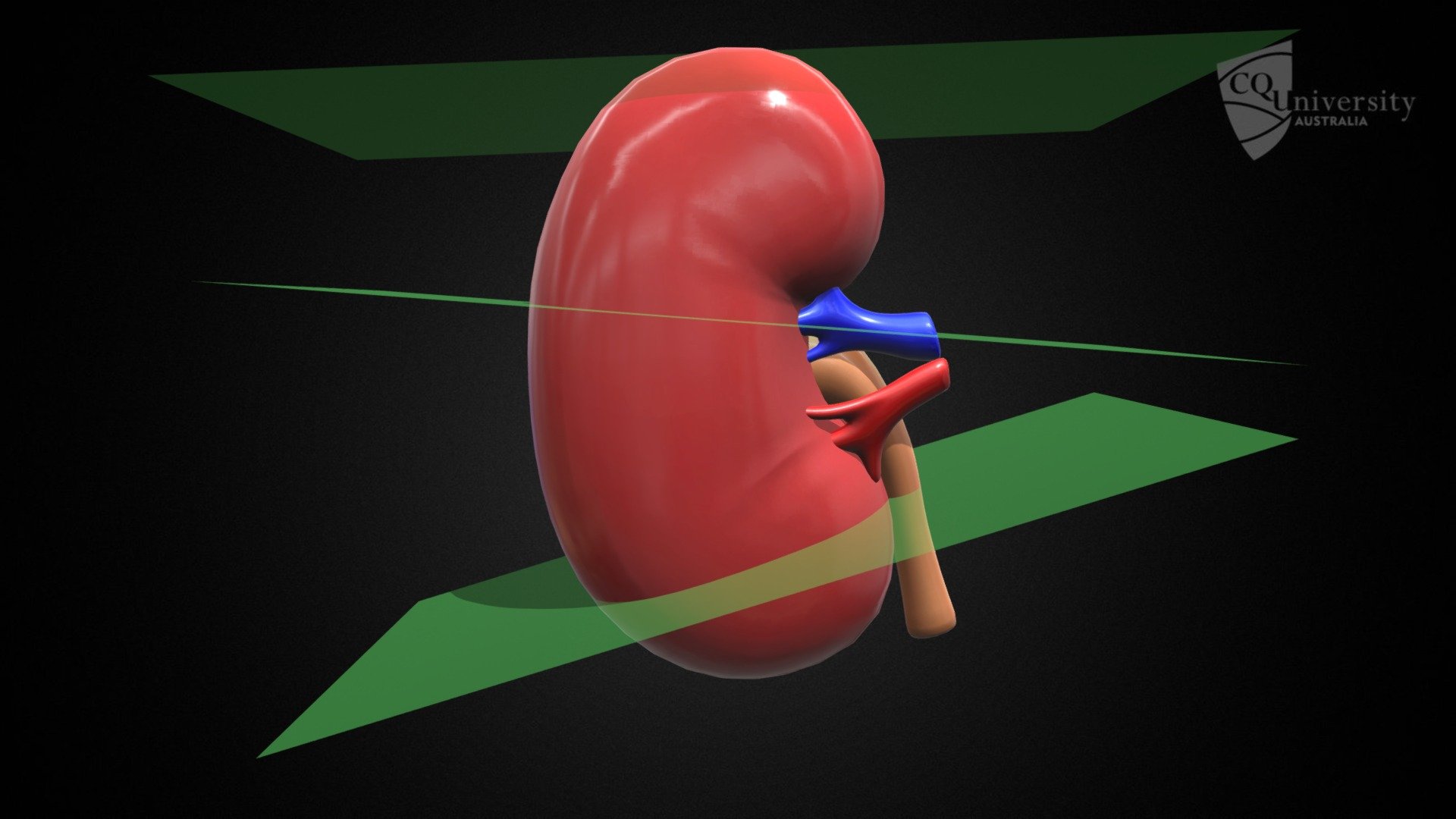 Kidney Lateral Planes - 3D model by CQUniversity Australia [2d7c885 ...
