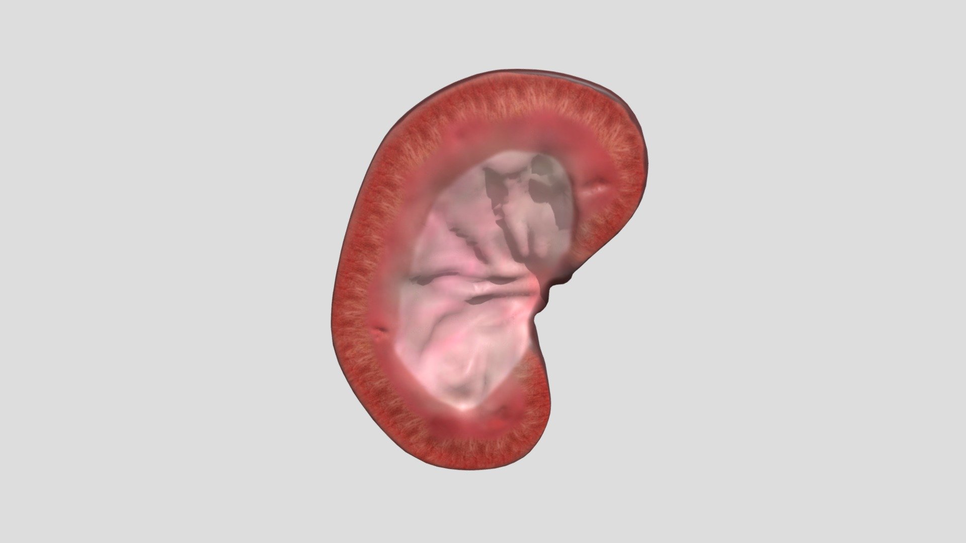 Hydronephrosis (Veterinary Pathology) - Download Free 3D model by ...