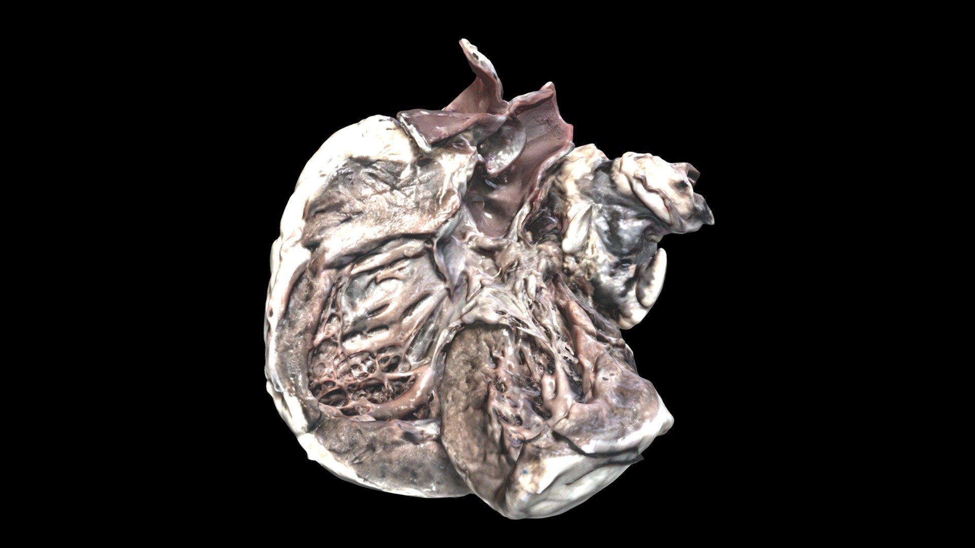 Subaortic stenosis I-482 - 3D model by Rohit Loomba (@loomba.rohit ...