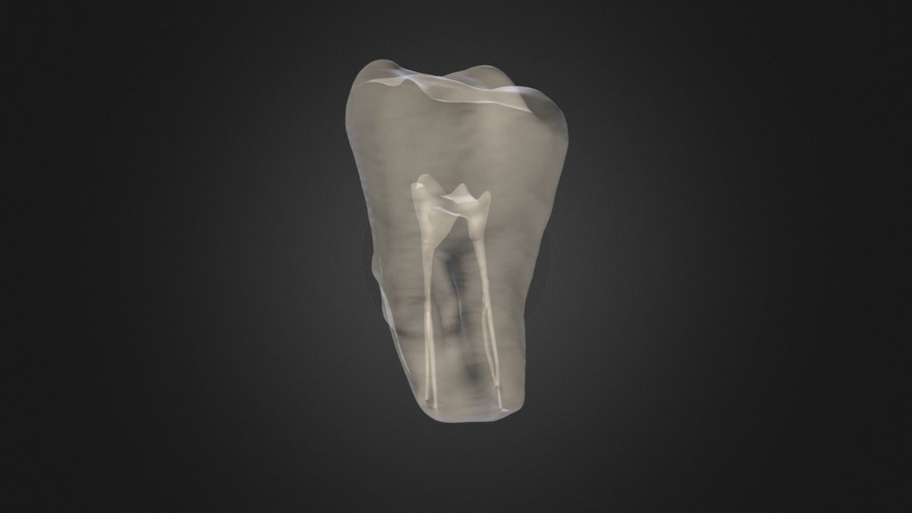 Tooth #4 5 - 3D model by 3DPMRC [2e2ea82] - Sketchfab