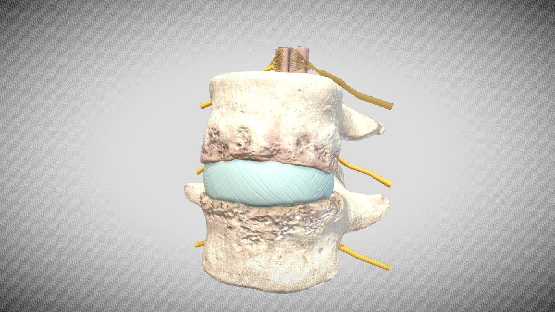 Syndesmophyte Formation - 3D model by imiridley [2e896a7] - Sketchfab