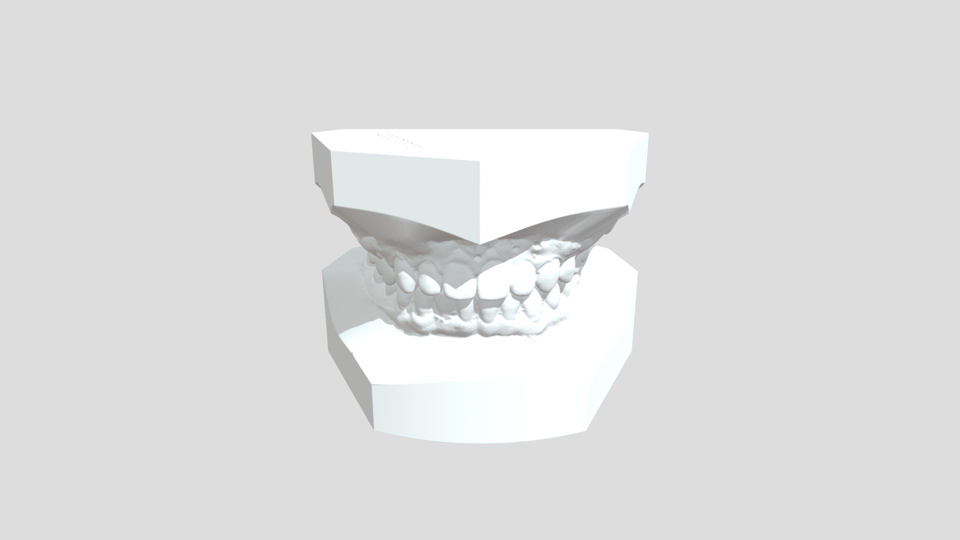 Case 4: Deep overbite case B model, CH Park - 3D model by orthonoh ...