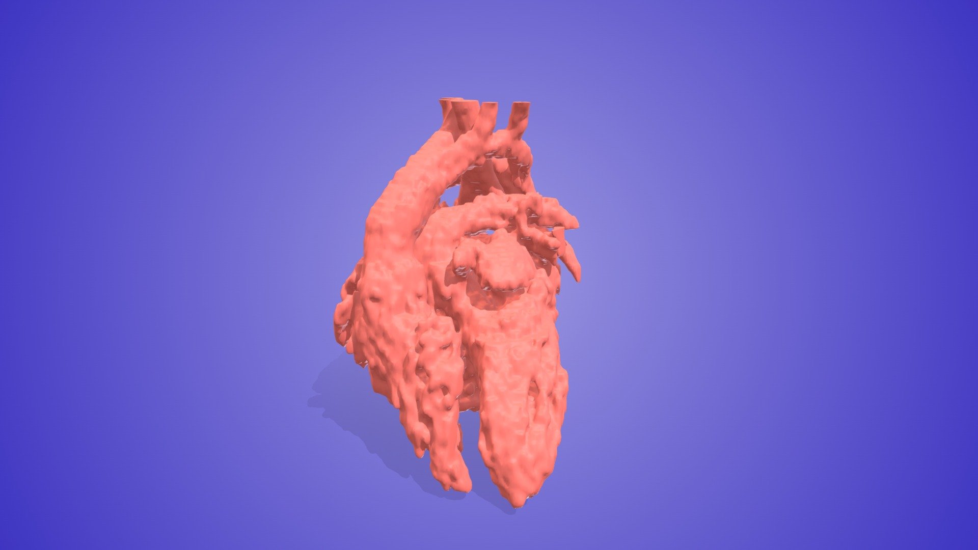 Dextro-Transposition of the Great Arteries - Download Free 3D model by ...