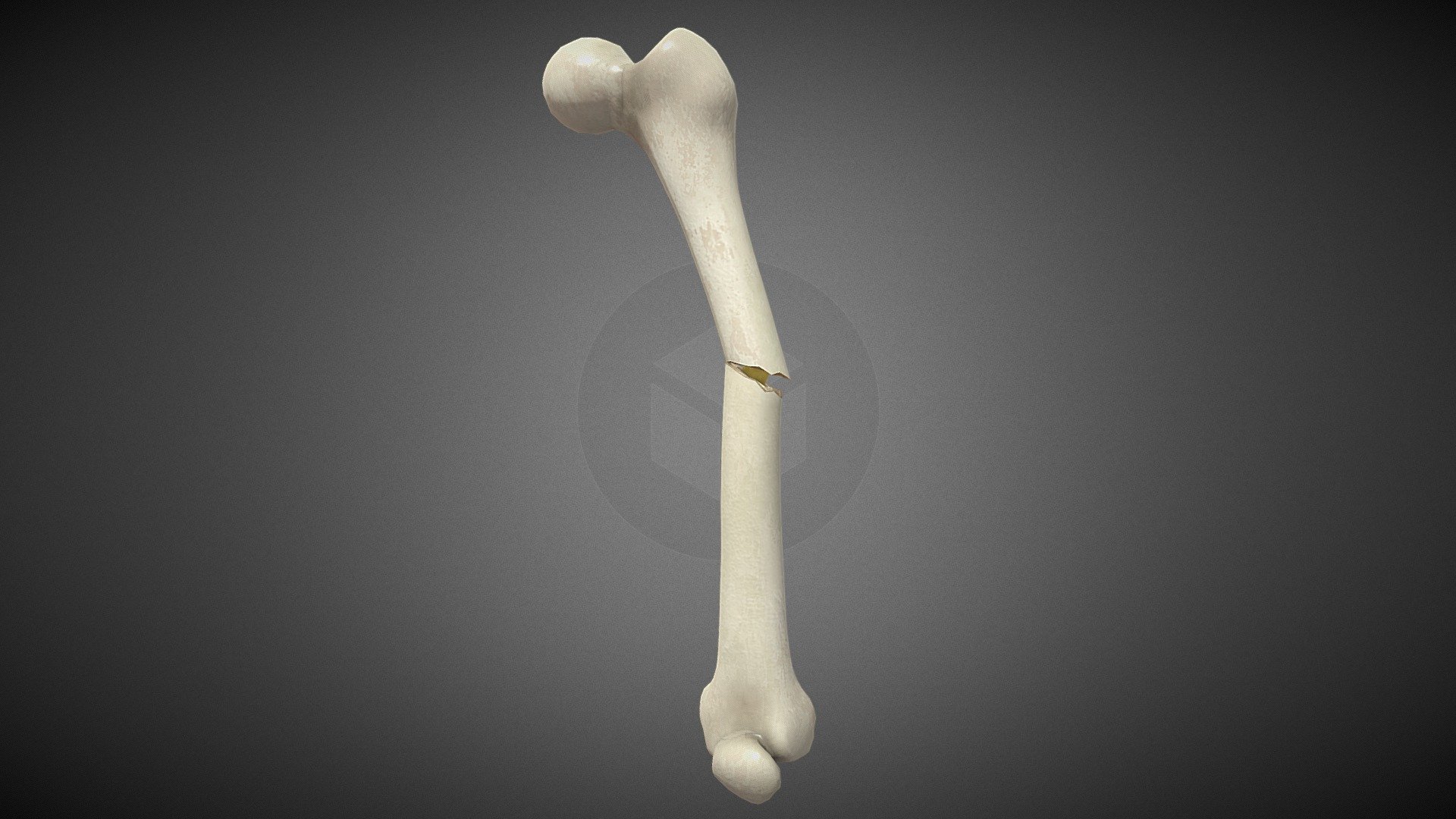Human Bone Fracture Animated - Buy Royalty Free 3D model by Devden ...