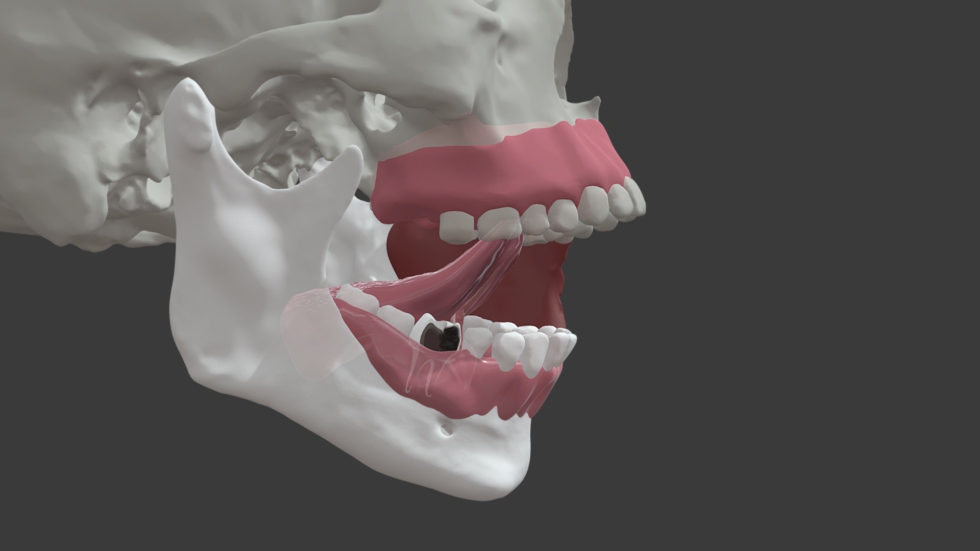Stage 3- Mandibular Molar Infection Pathway 3 - 3D model by University ...