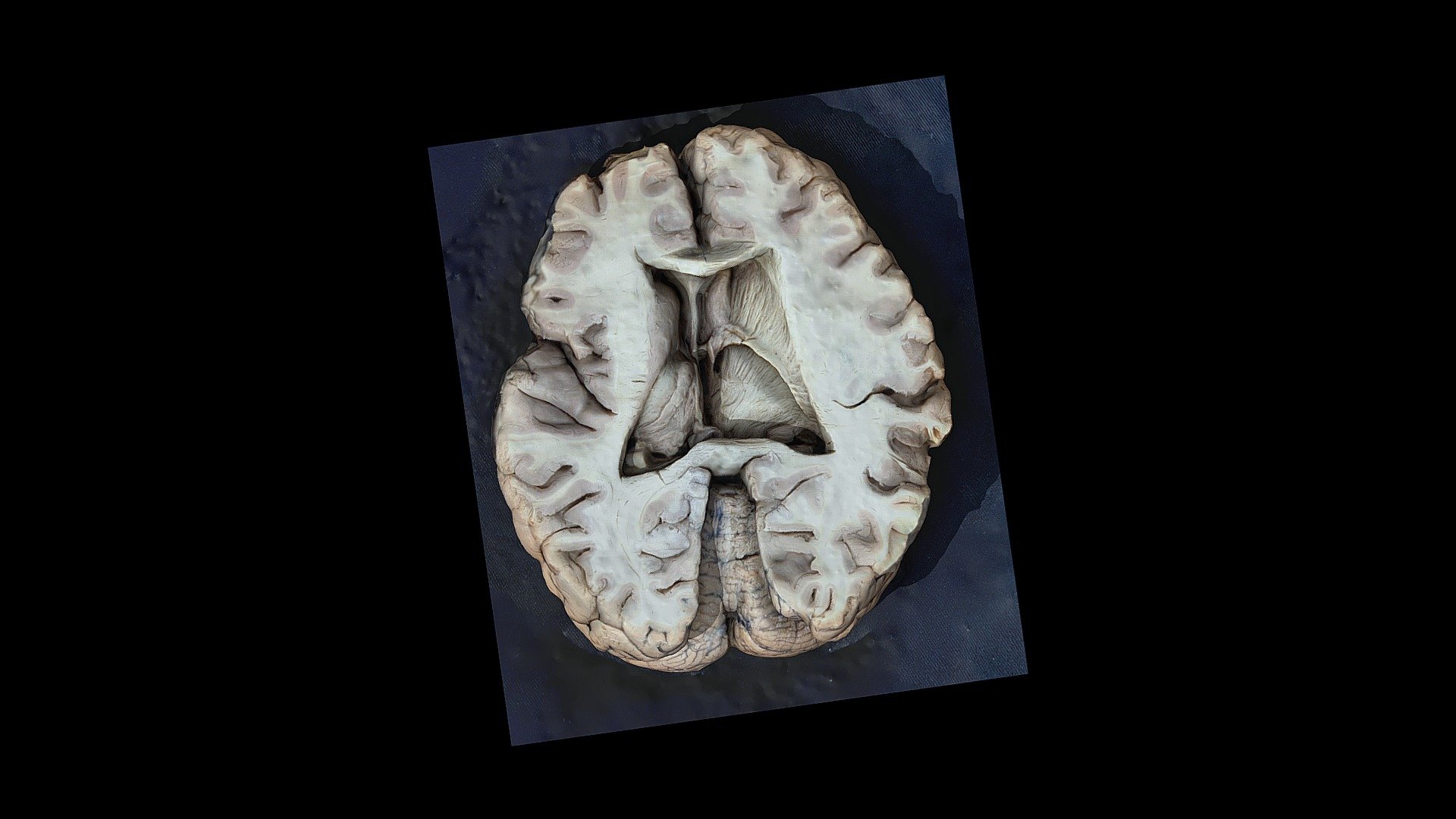 Zona Incerta - 3D model by Istanbul-Microneurosurgery ...
