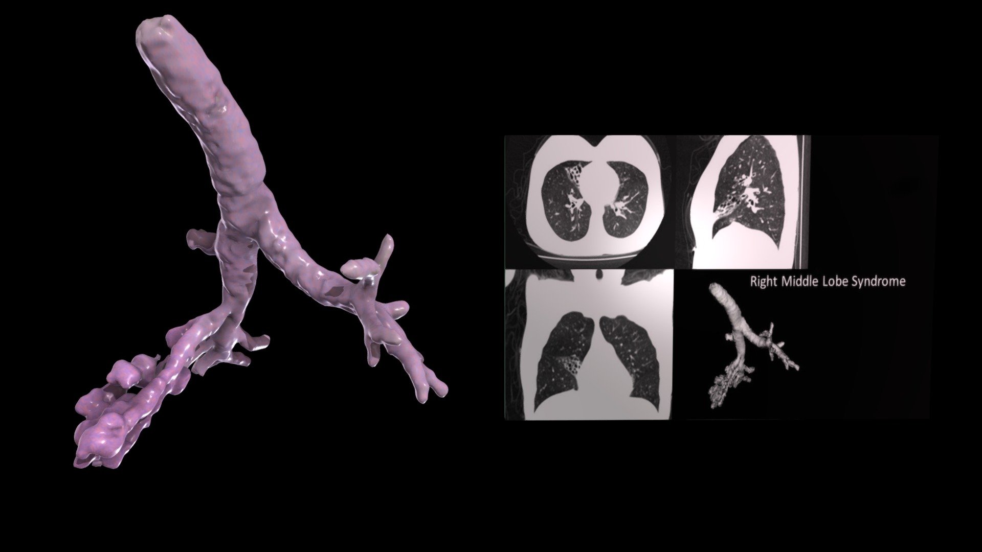 Right Middle Lobe Syndrome - 3D model by tl0615 [3093d21] - Sketchfab