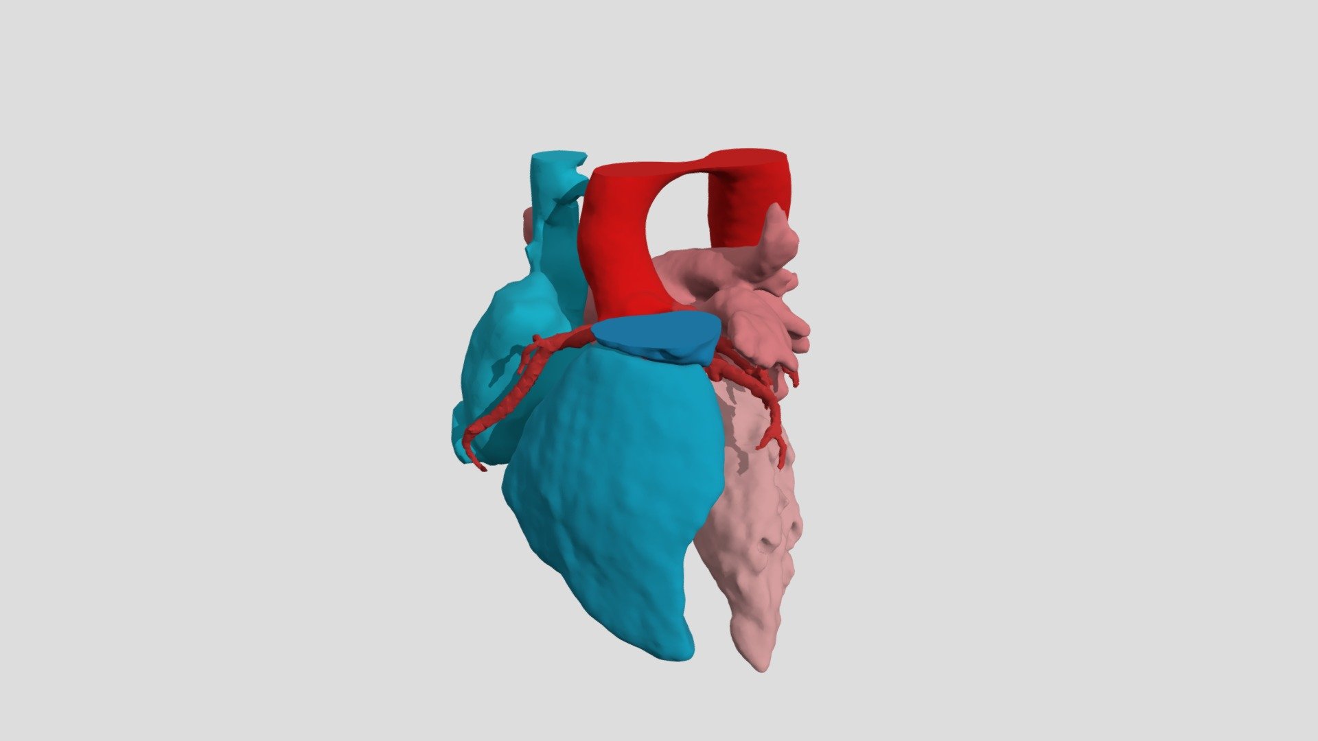 Anomalous Origin of LCA Post-Op (S0257) - 3D model by NCH Advanced ...