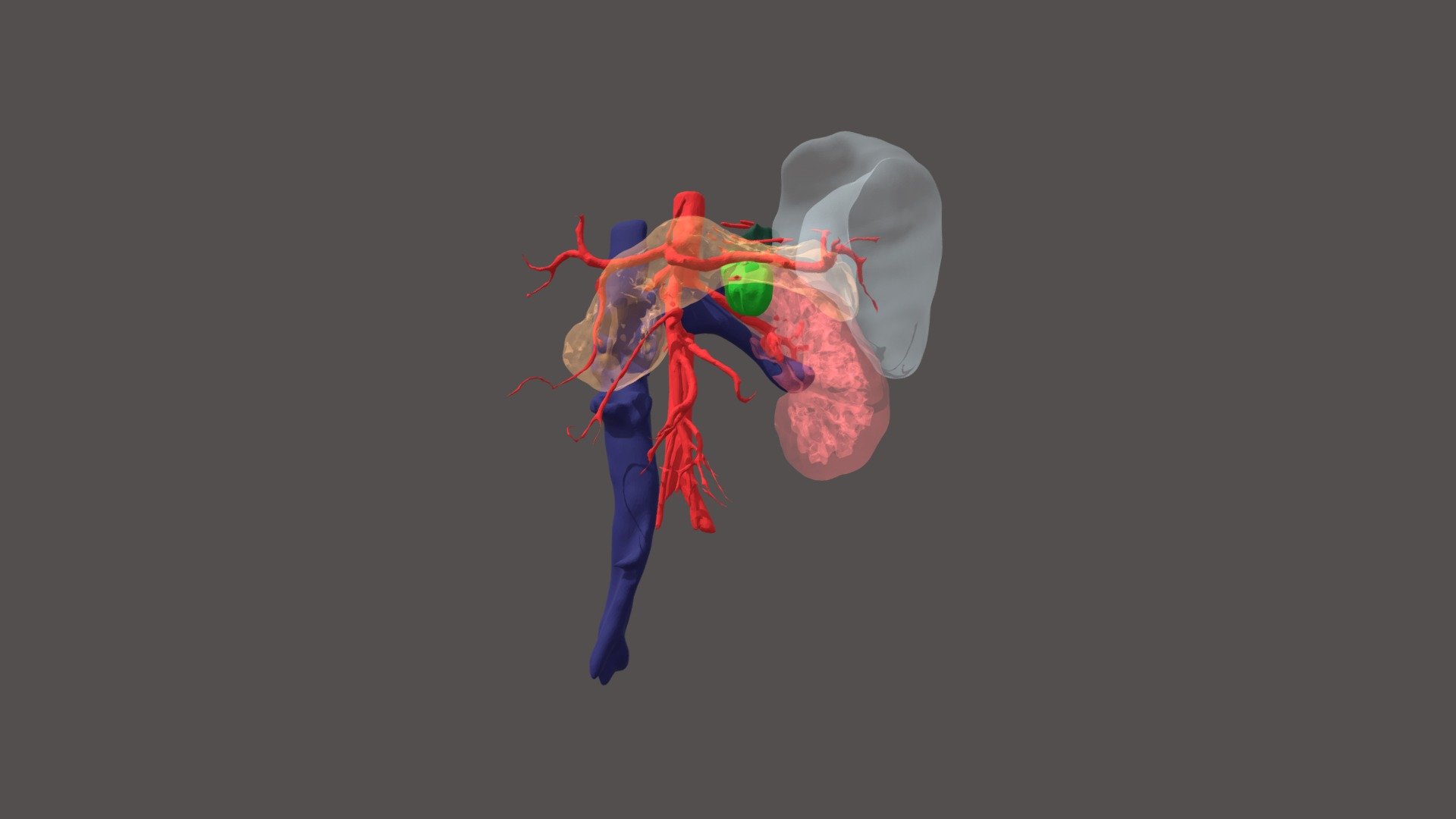 Adrenal tumor - 3D model by thorac.topsurgery [31c8bc5] - Sketchfab