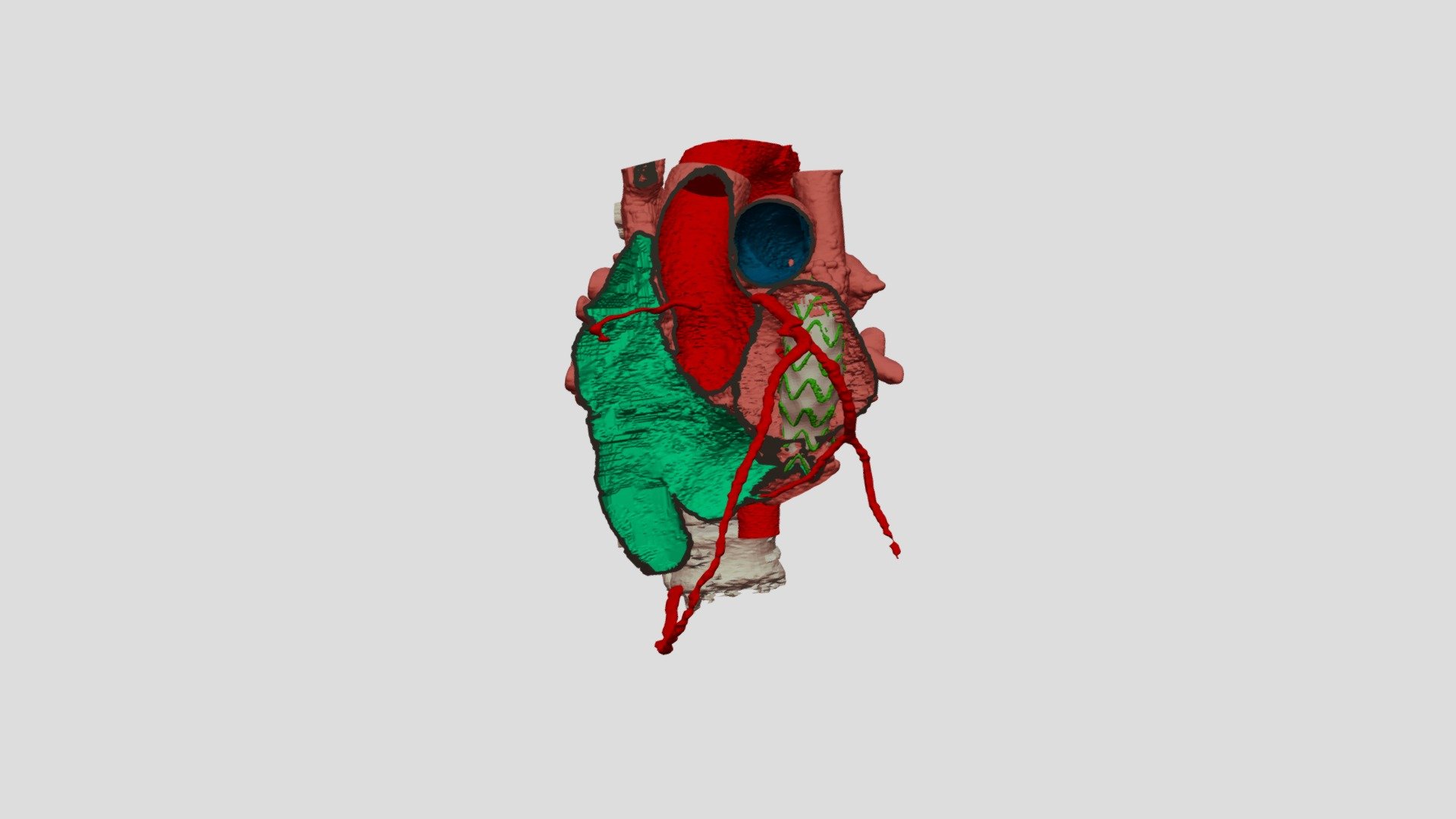 Dextrocardia & Coronary Sinus Septal Defect - 3D model by NCH Advanced ...