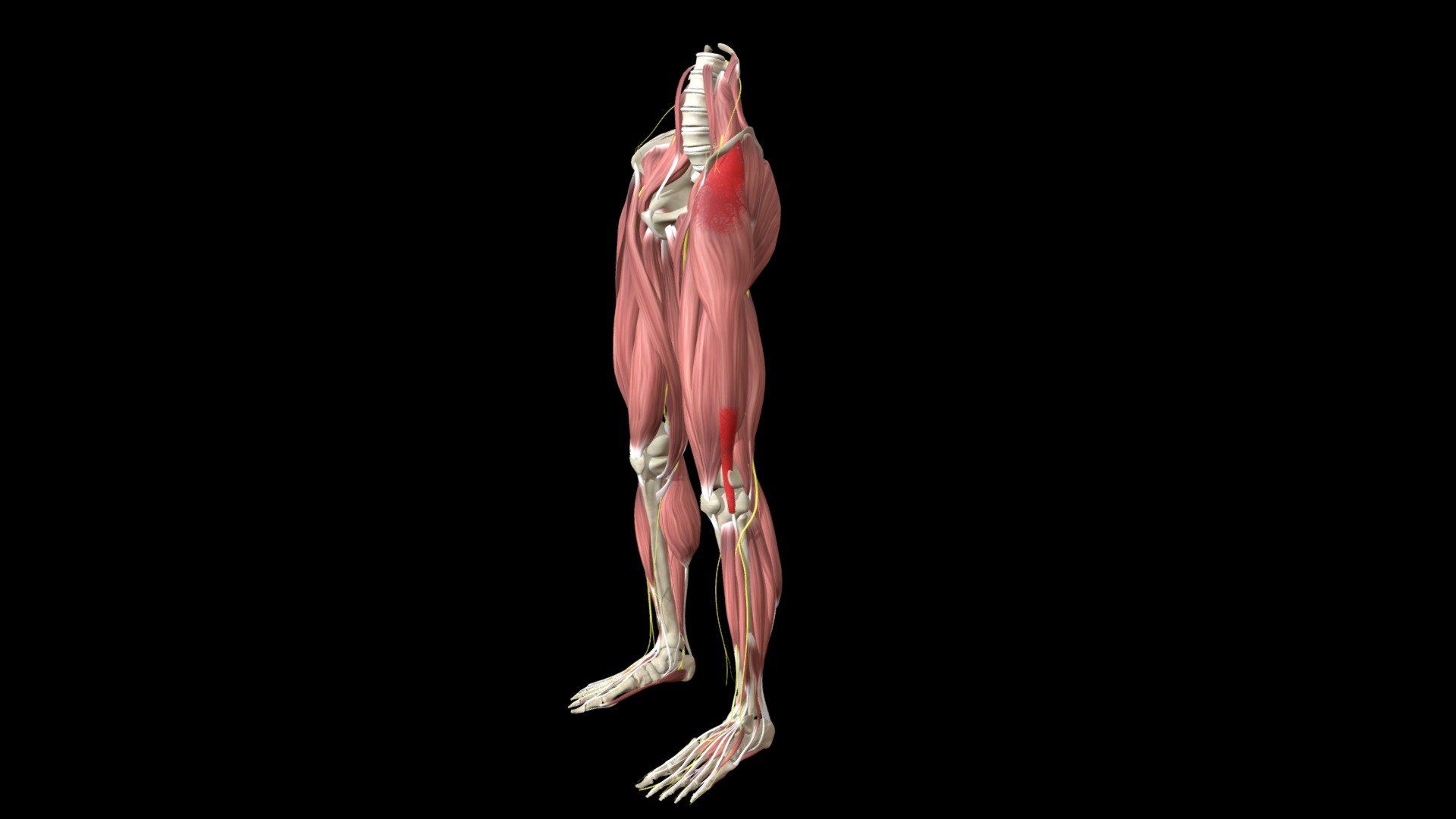 Iliotibial Band Syndrome, Tensor Fascia Latae - 3D model by IU ...
