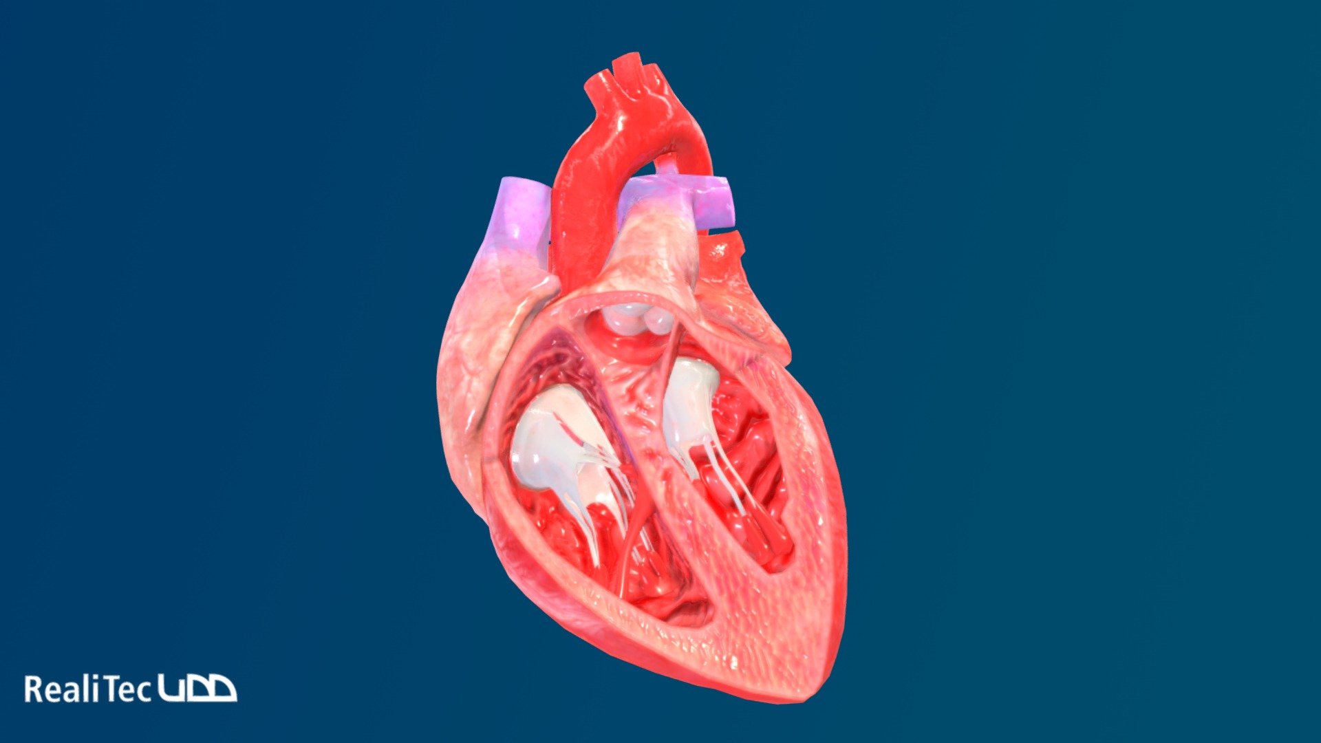 Ductus arterioso persistente (DAP) - 3D model by UDD - Centro de ...