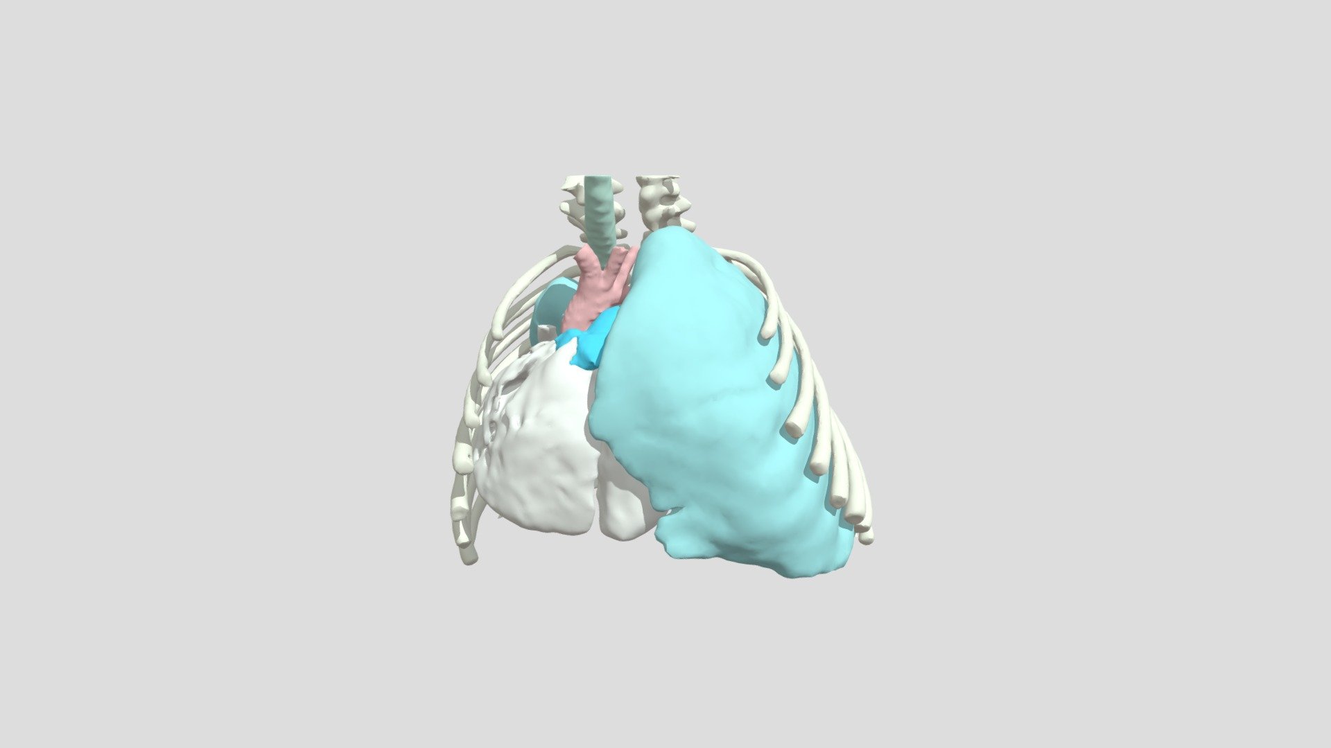 Hypoplastic Left Lung, PDA, Aortic Arch (S0389) - 3D model by NCH ...