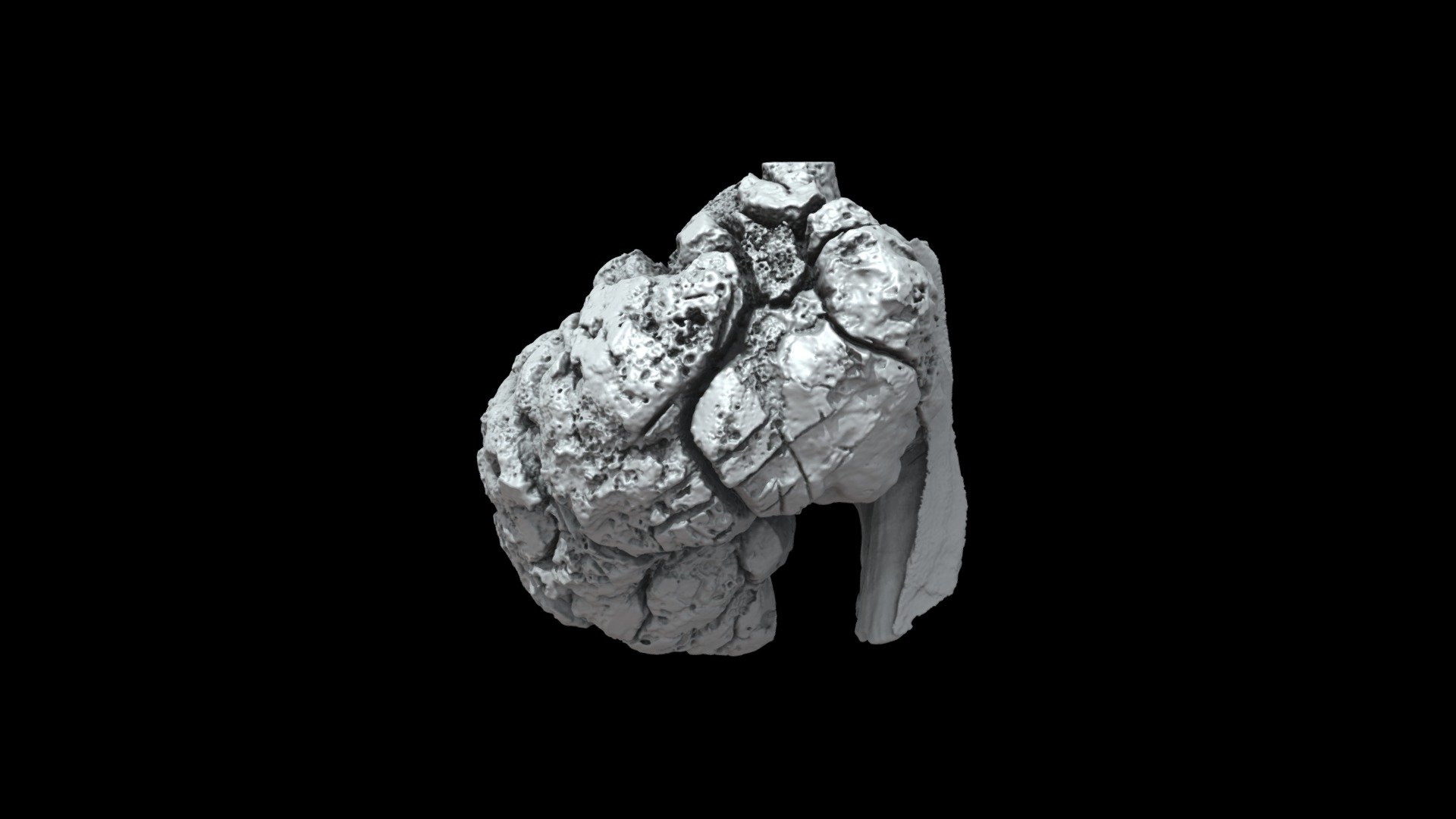 Left human femur w. osteosarcoma (VCU_3D_5247) - 3D model by Virtual ...