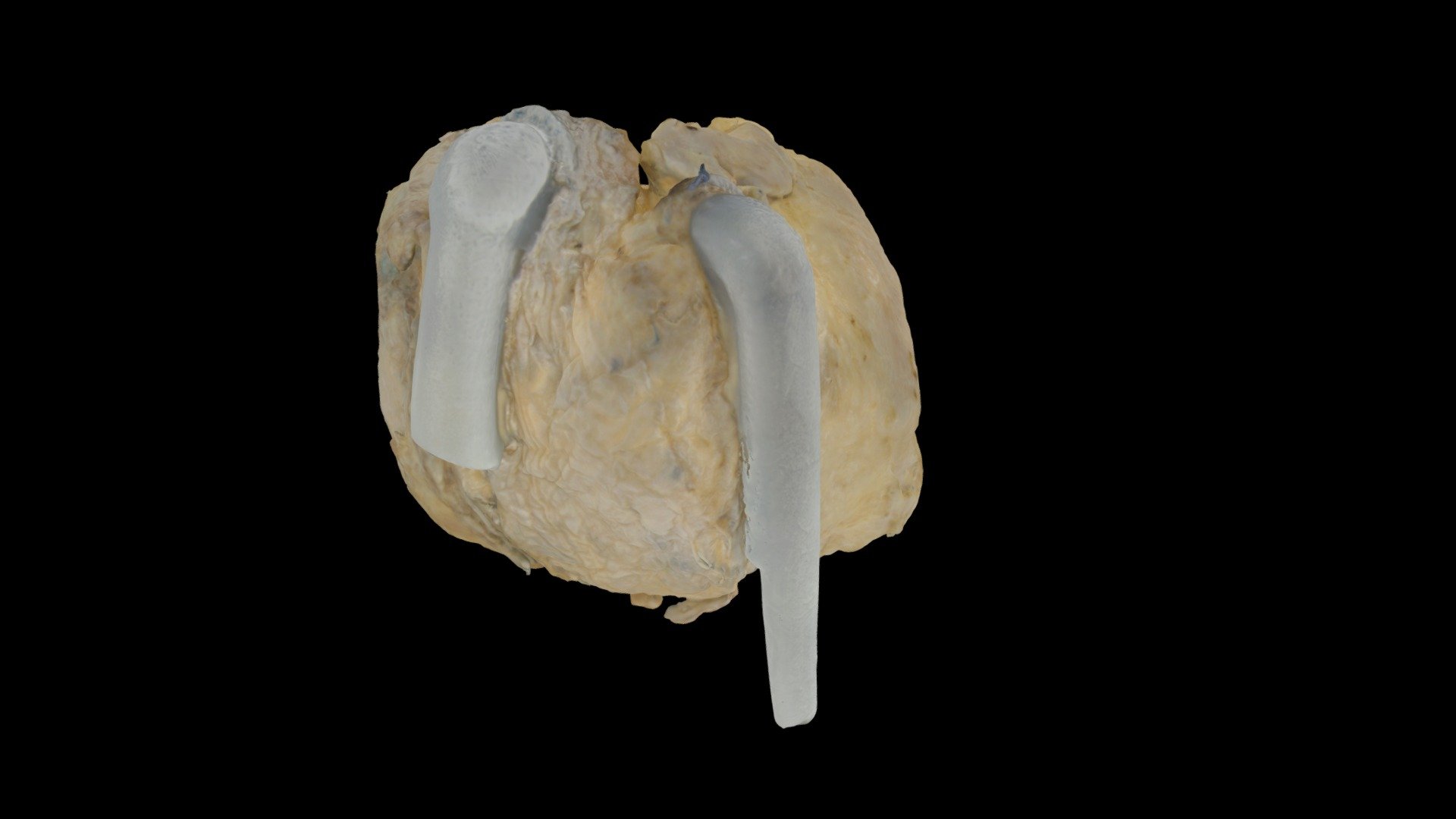 Pediatric Congenital Heart Disease Model - Download Free 3D model by ...
