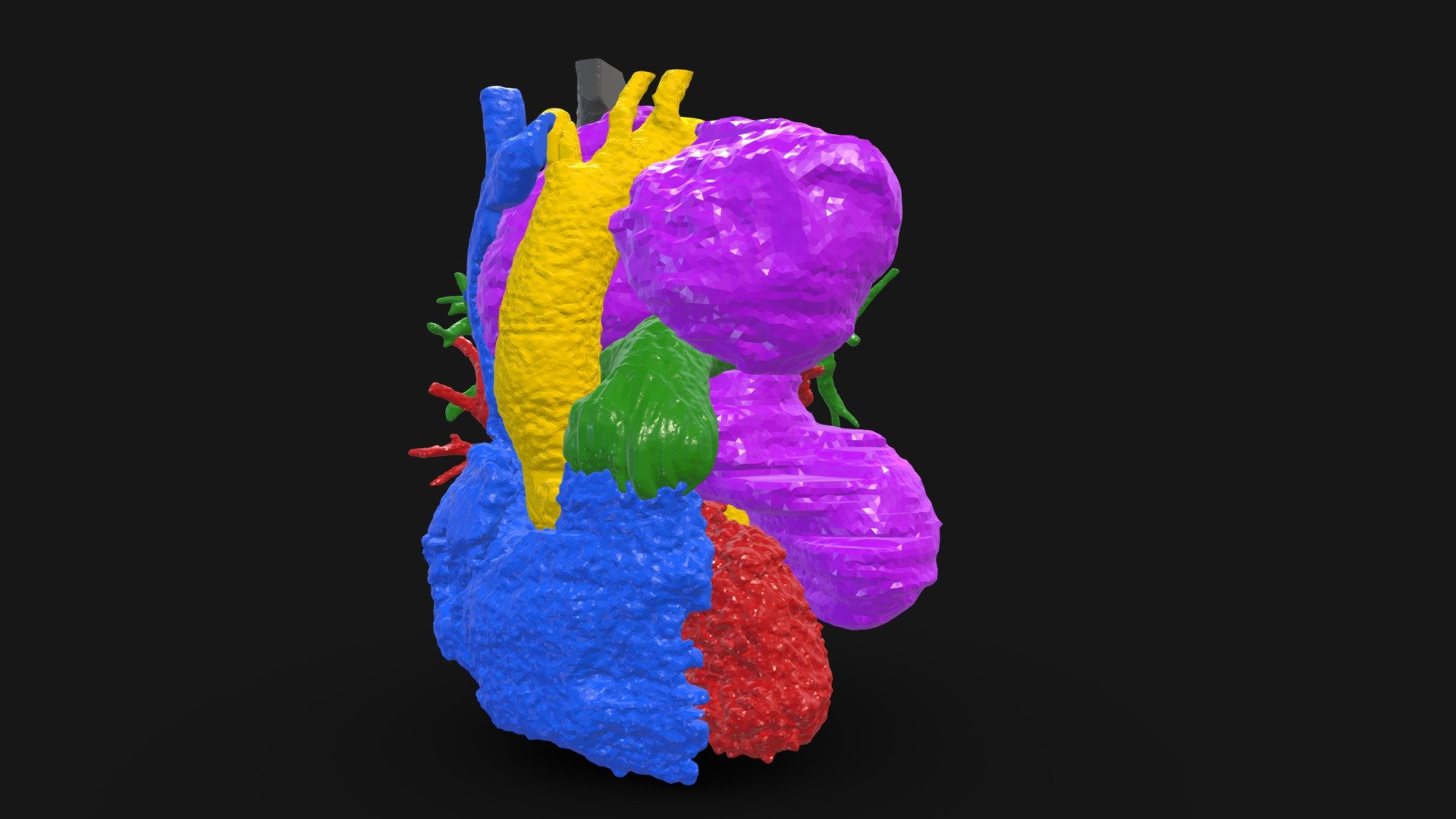 Complex Mediastinal Tumor - Solid Tumor View - 3D model by APIL (@apil ...