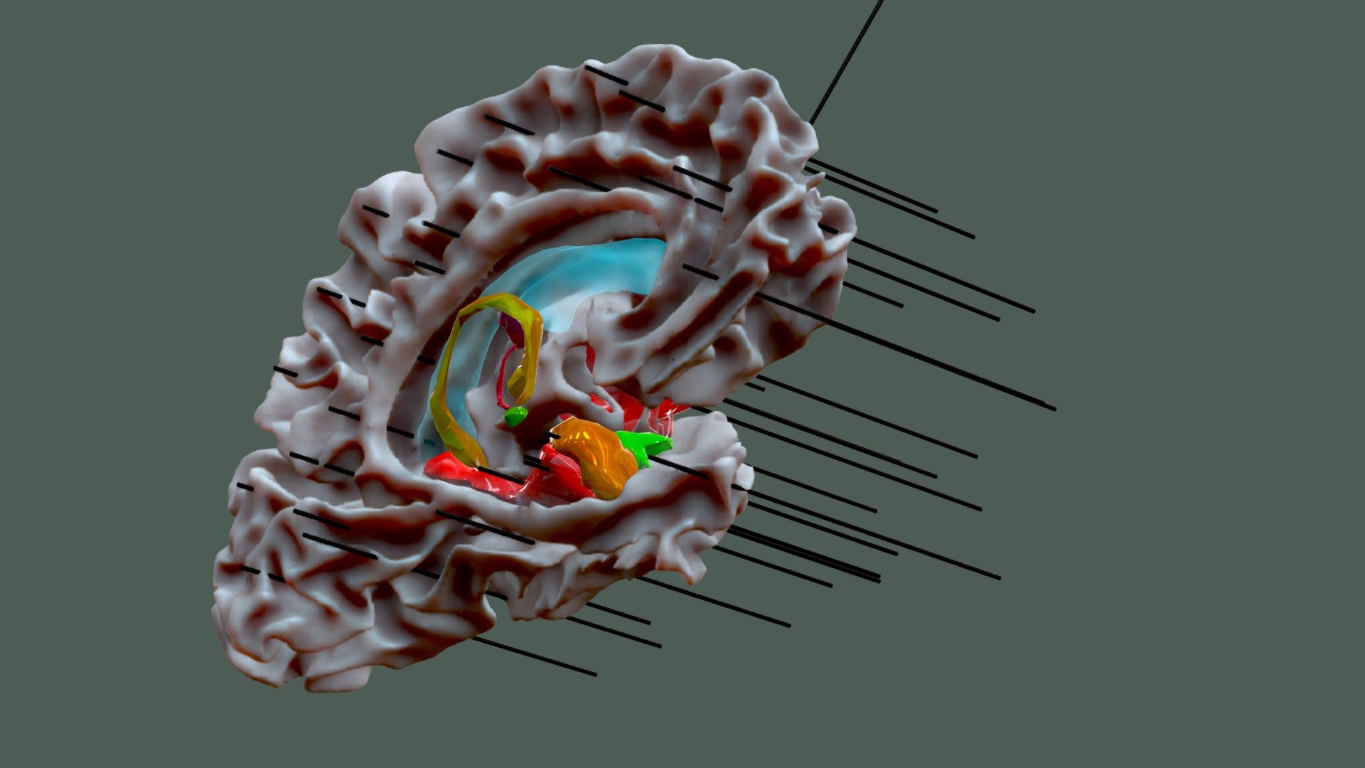 schematic representation of SEEG electrodes - 3D model by Juan Arias ...