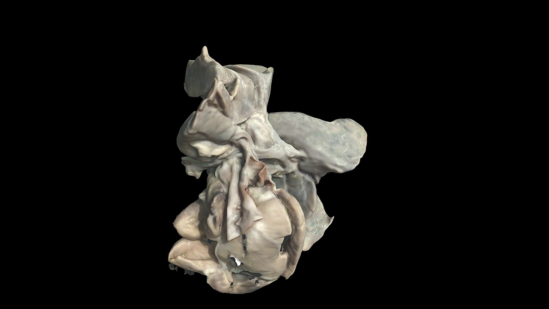Total anomalous pulmonary veins I-744 - 3D model by Rohit Loomba ...