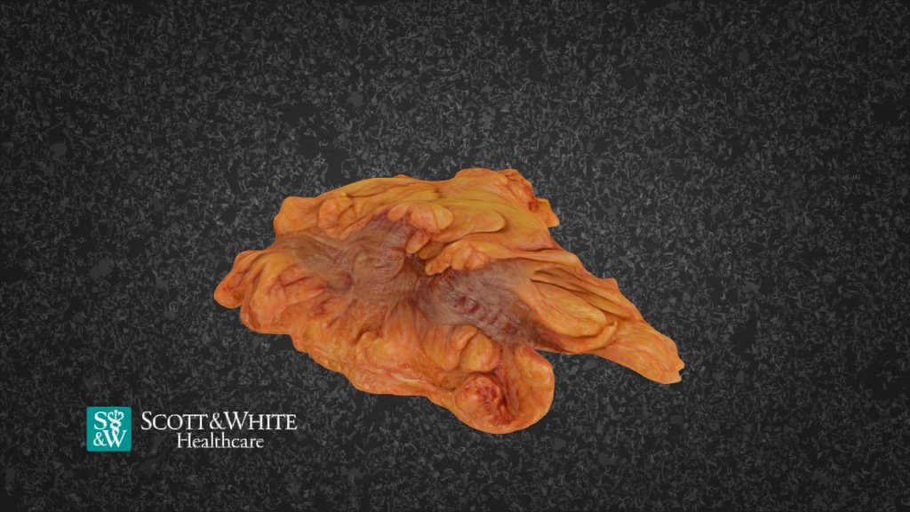 Sigmoid Adenocarcinoma 210769 - 3D model by Scott & White Moulage ...