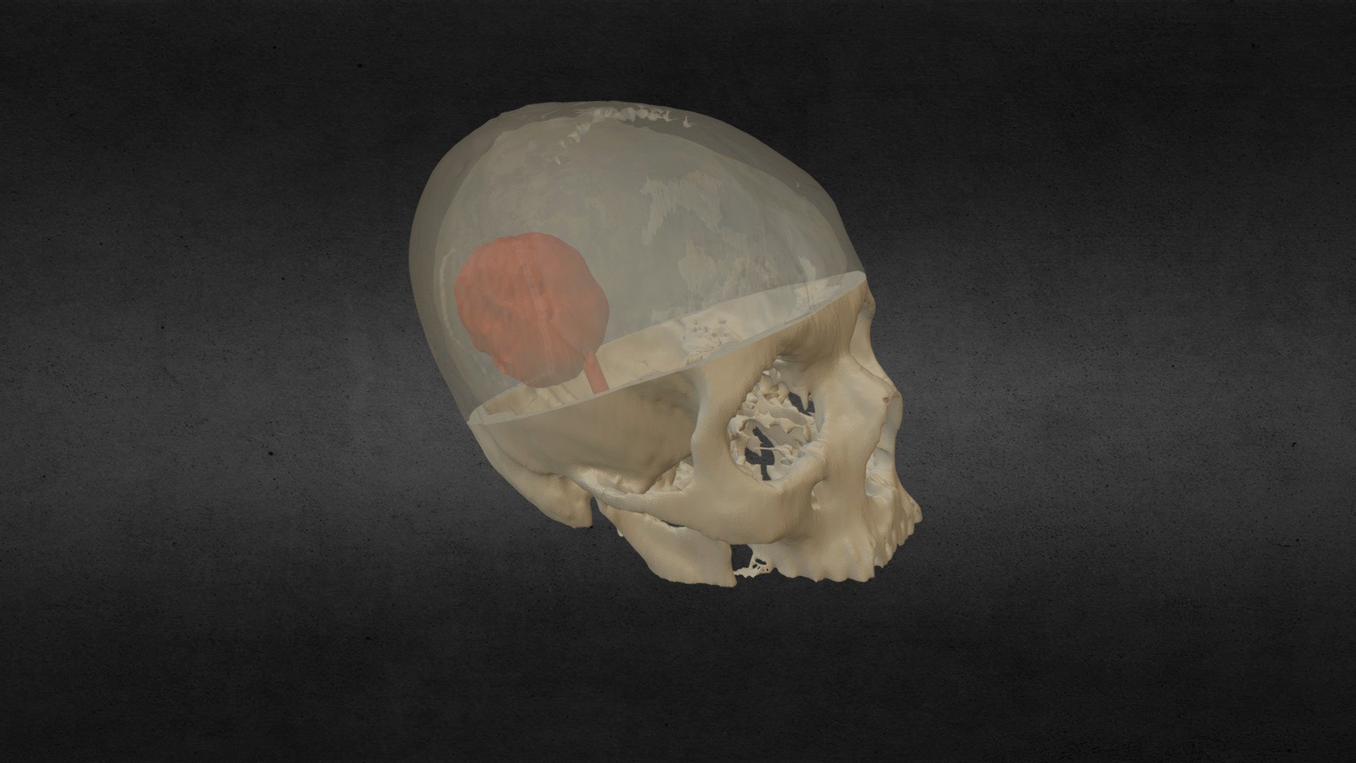 Tumor - 3D model by Justin Cramer (@jcramer) [358db44] - Sketchfab