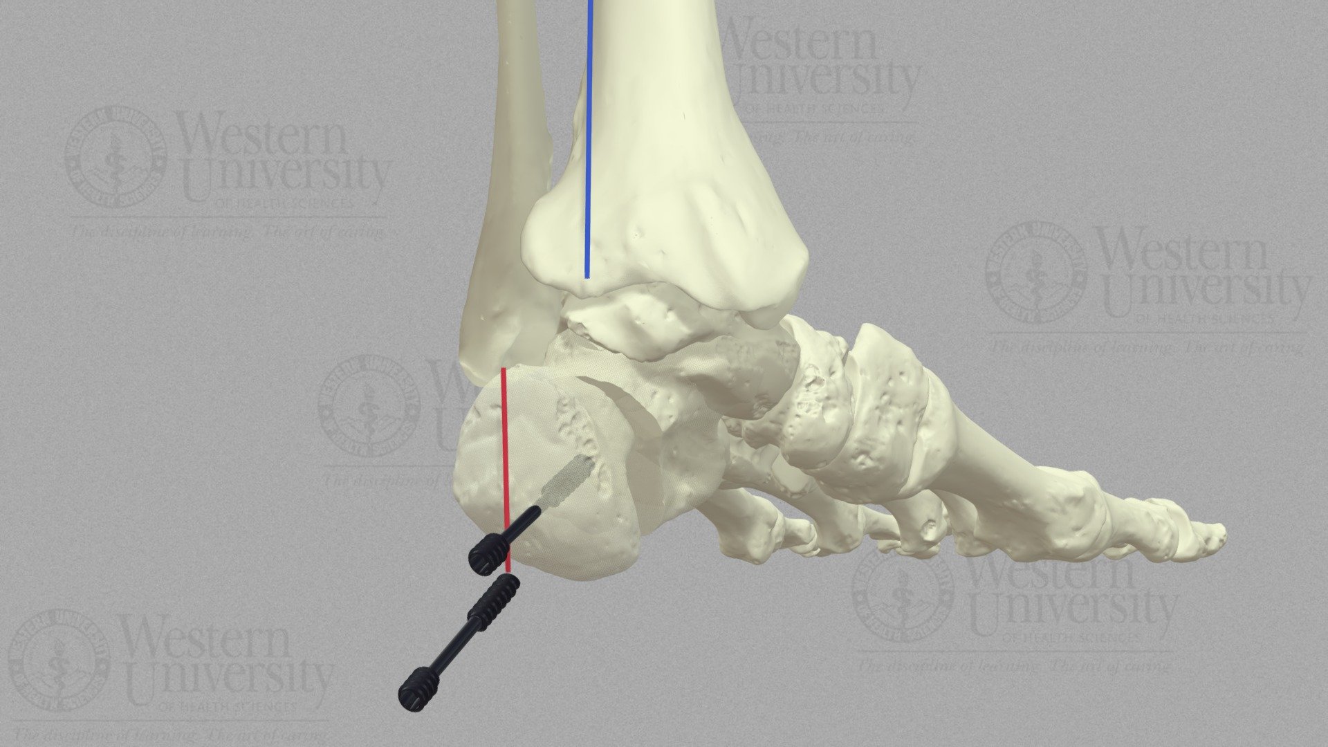 Lateral Calcaneal Slide Osteotomy - 3D model by WesternU3D [3604159 ...