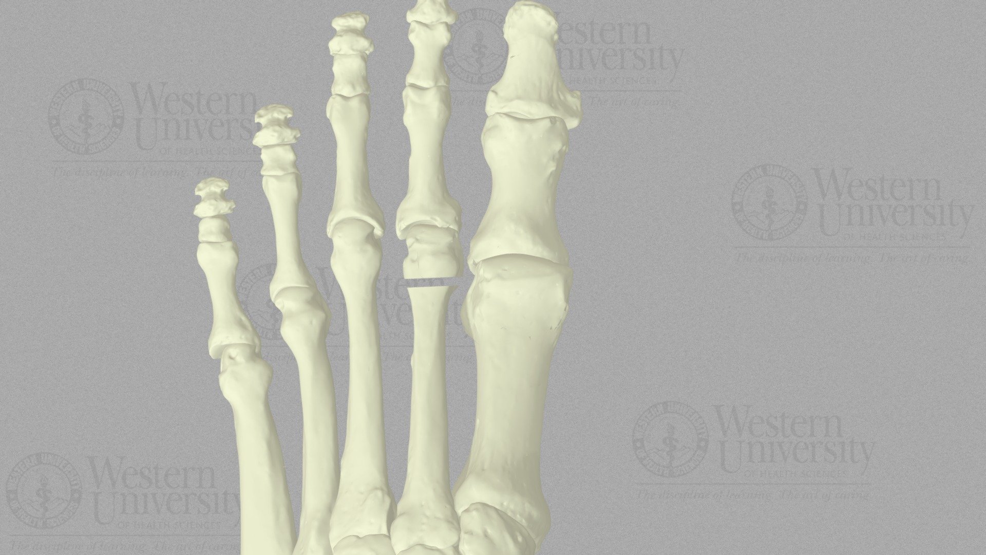 Distal Osteotomy of Lesser Metatarsal - 3D model by WesternU3D [365852b ...