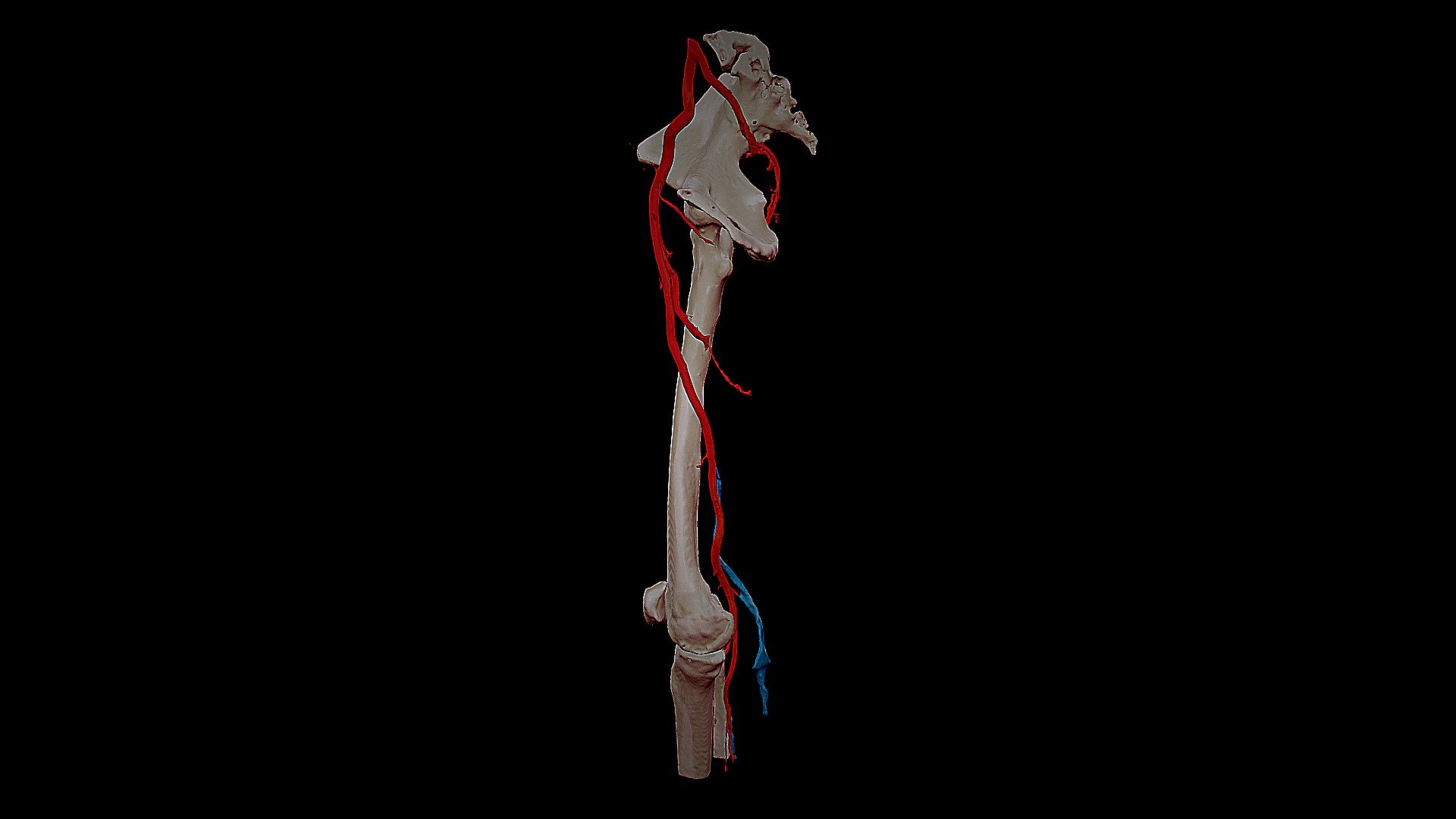Popliteal Arteriovenous Fistula PhleboTCMD - Download Free 3D model by ...
