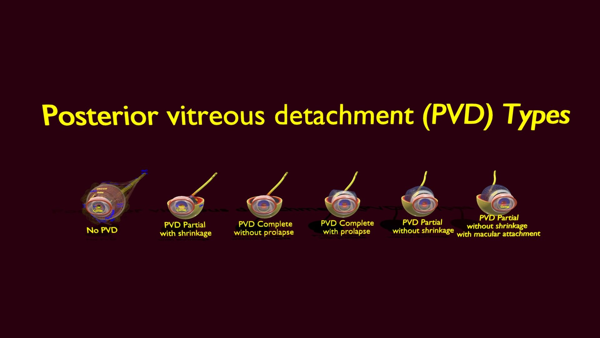 Vitreous detachment types posterior prolapse - Buy Royalty Free 3D ...