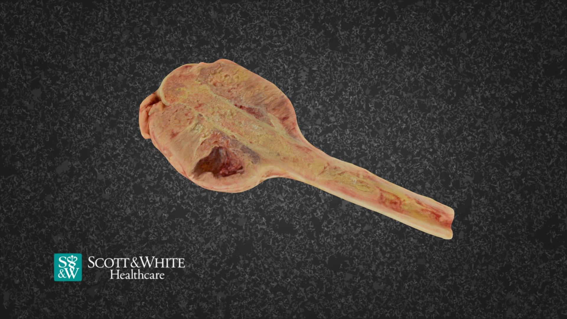 Osteosarcoma of the Femur Dissected- 307322 - 3D model by Scott & White ...