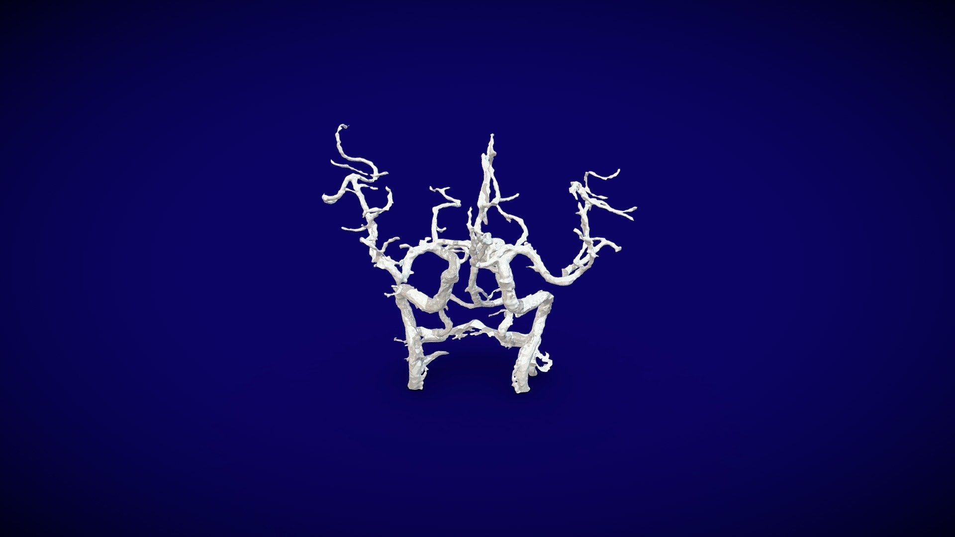 MJF - Complex Basilar Tip Aneurysm - 3D model by Dr. Samuel Damin ...