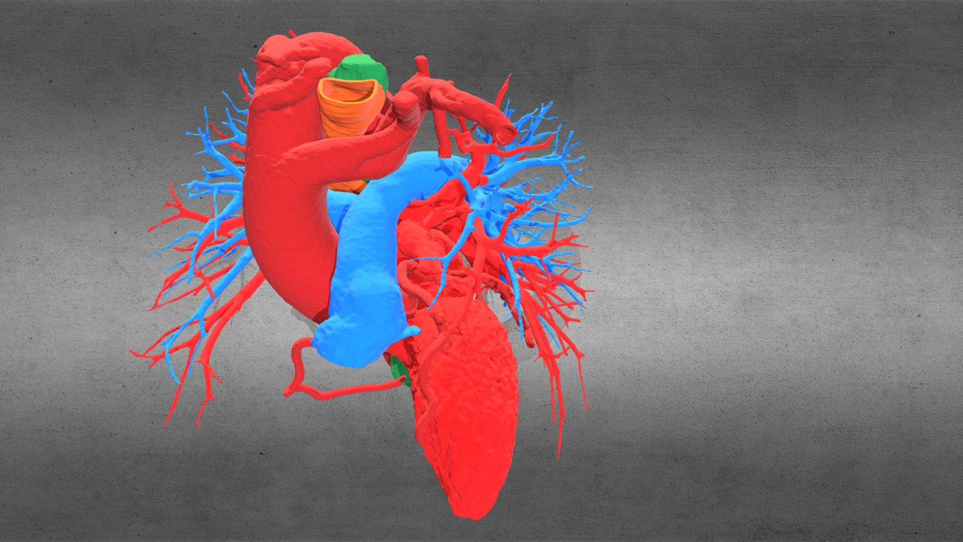 Aortic vascular ring - 3D model by Abdel Hakim Moustafa (@AMoustafa_MD ...