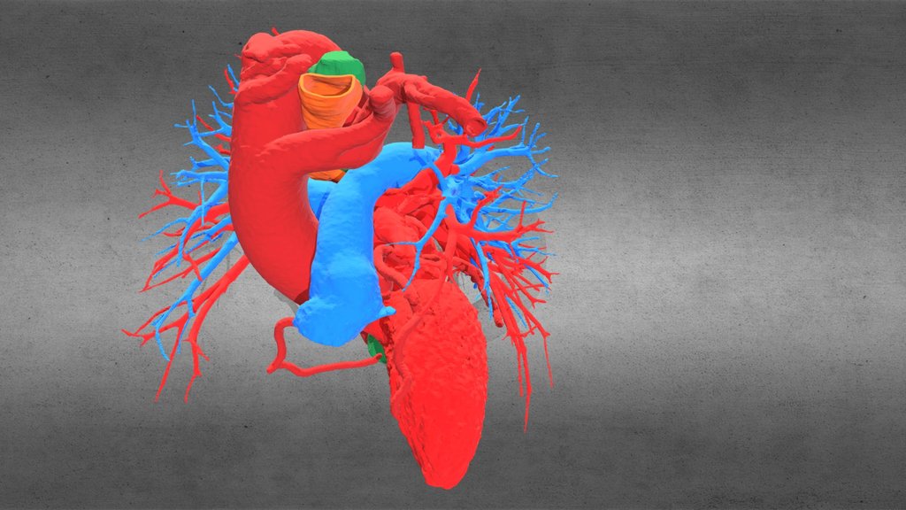 Aorta - A 3D model collection by Abdel Hakim Moustafa (@AMoustafa_MD ...