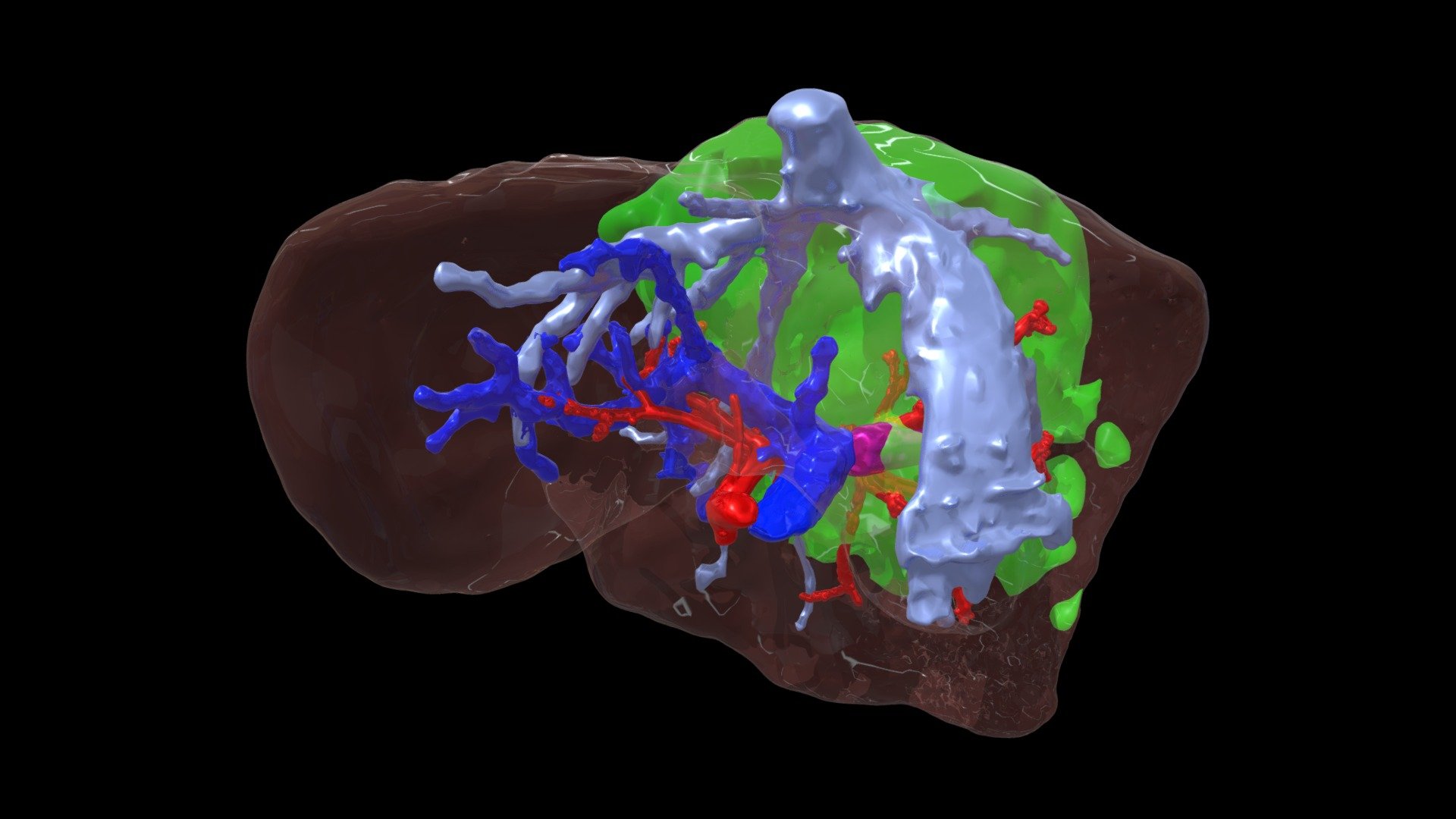 Liver Tumors - 3D model by Tecdes SA (@tecdessa) [3aa9de6] - Sketchfab