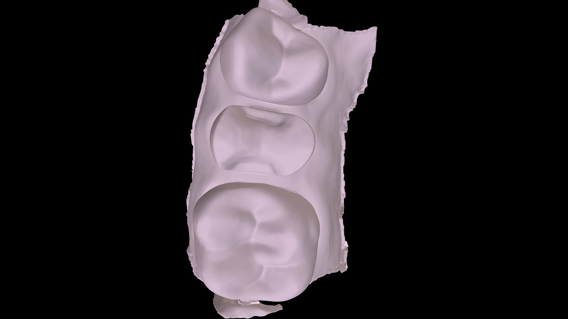Composite Onlay Preparation - 3D model by bchui [3b22eee] - Sketchfab