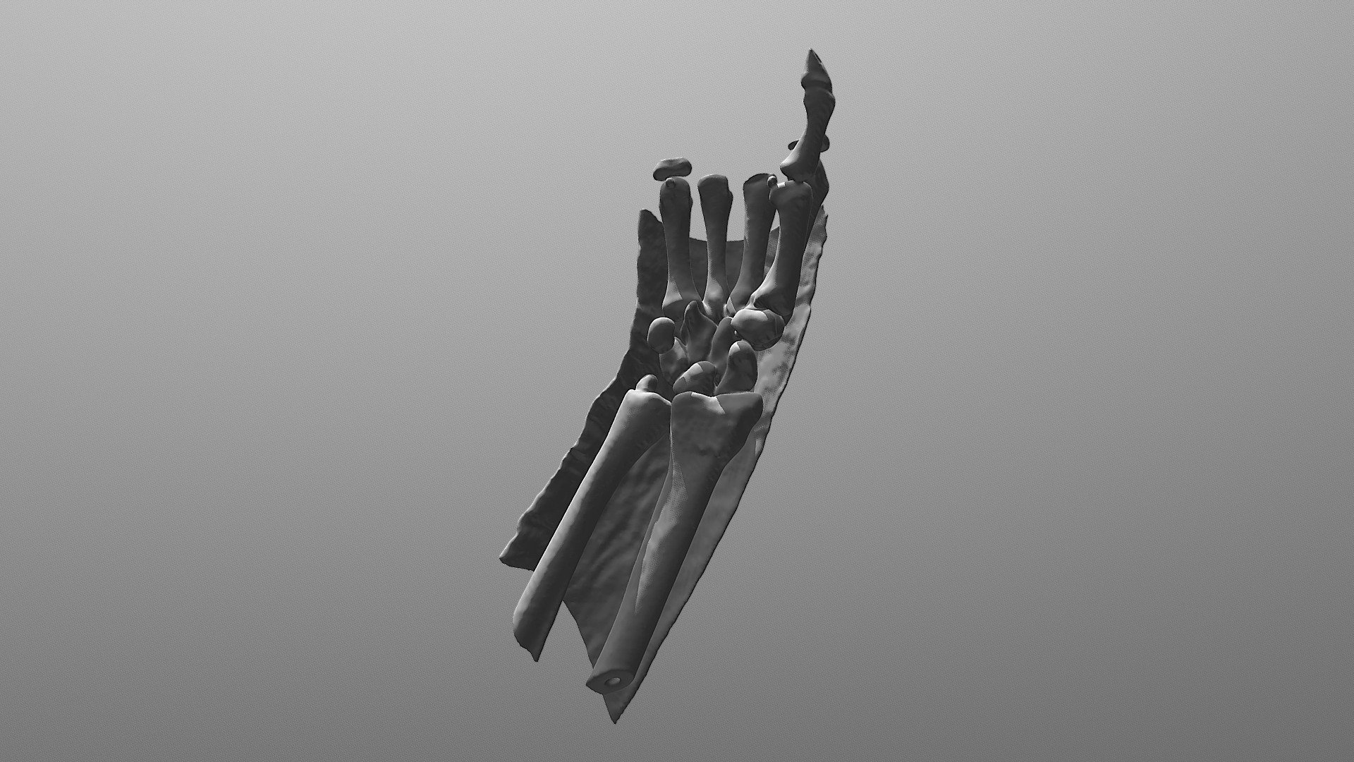 Fracture of the distal radius after reposition - Download Free 3D model ...